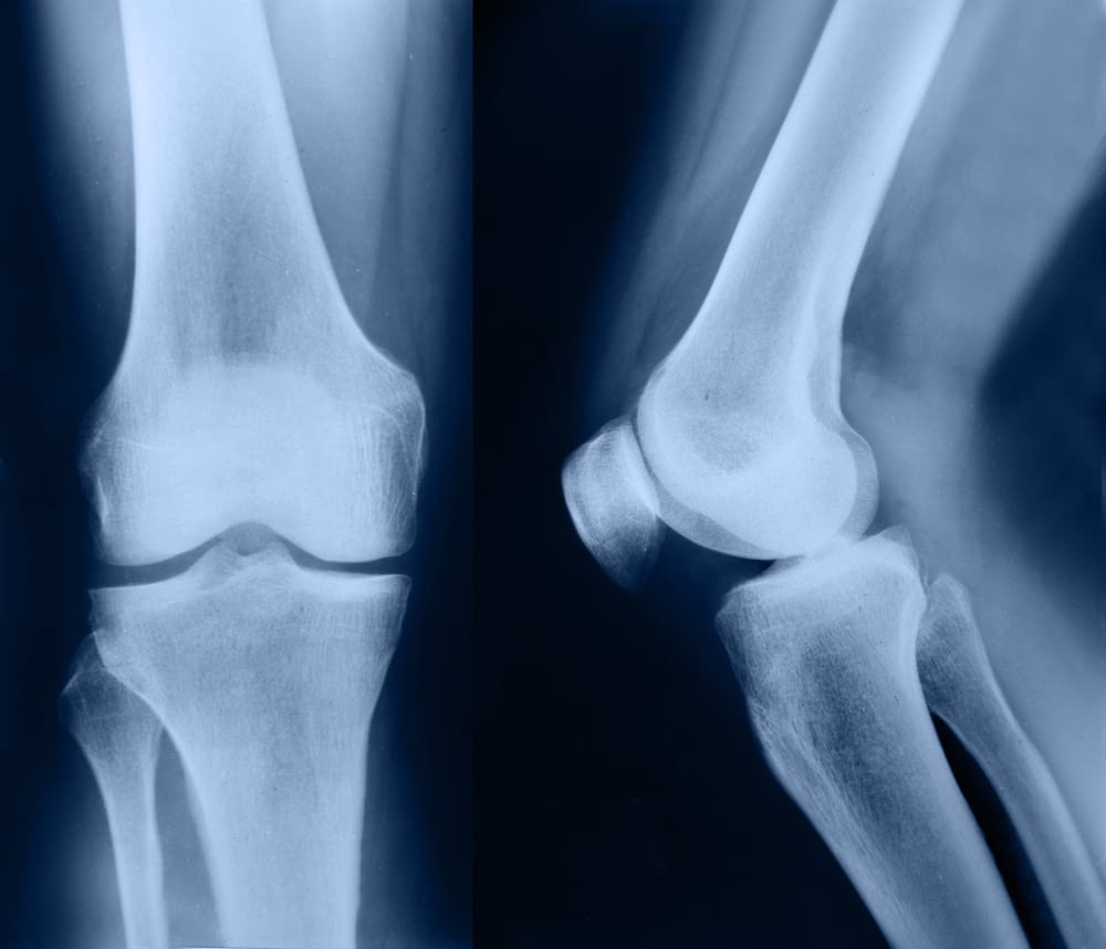 Osteotomy - Mr. Chris Wilson - Orthopaedic & Knee Surgeon Cardiff
