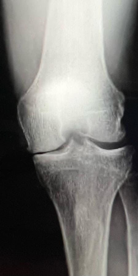 The Power Of Osteotomy - Mr. Chris Wilson - Orthopaedic & Knee Surgeon ...